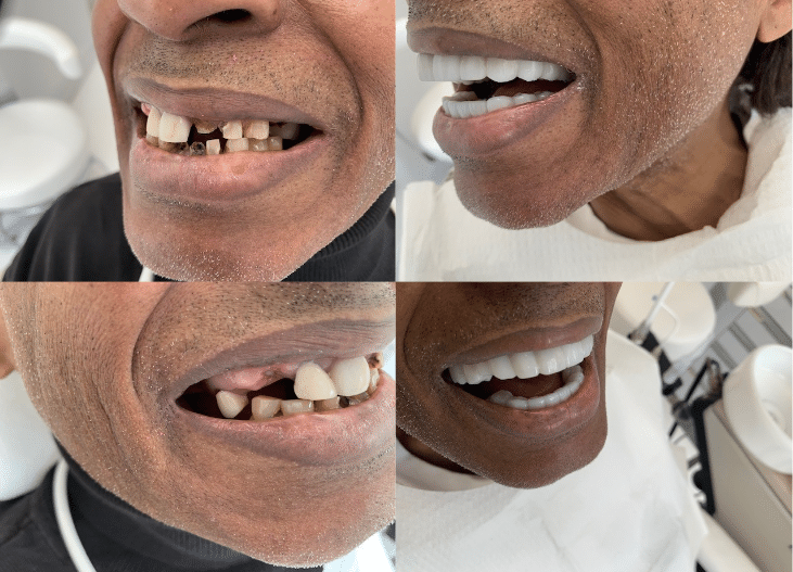 Smile Makeover in Los Angeles | Dr. Anthony Mobasser